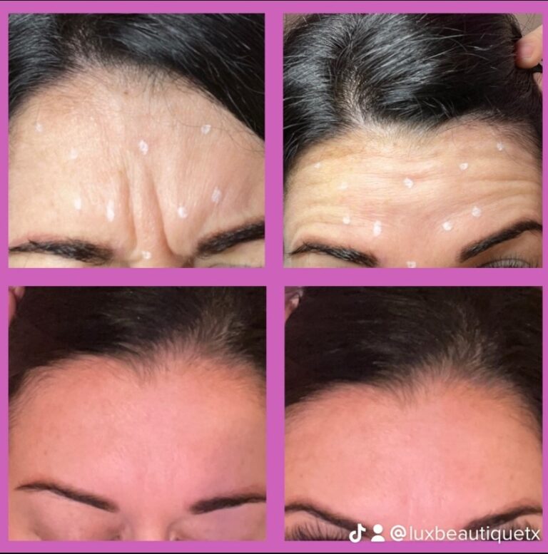 Before and After Botox Pics - Lux Beautique